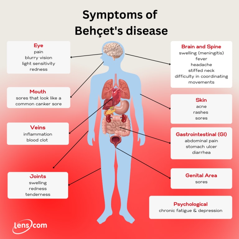 Behçet’s Disease: Symptoms, Causes, and Treatment Explained | eyeSTYLE ...