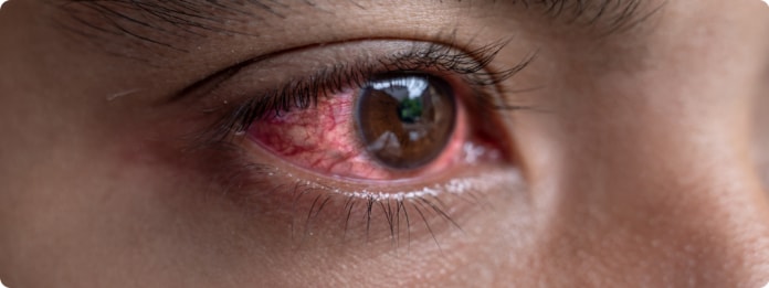 Behçet’s Disease: Symptoms, Causes, and Treatment Explained | eyeSTYLE ...